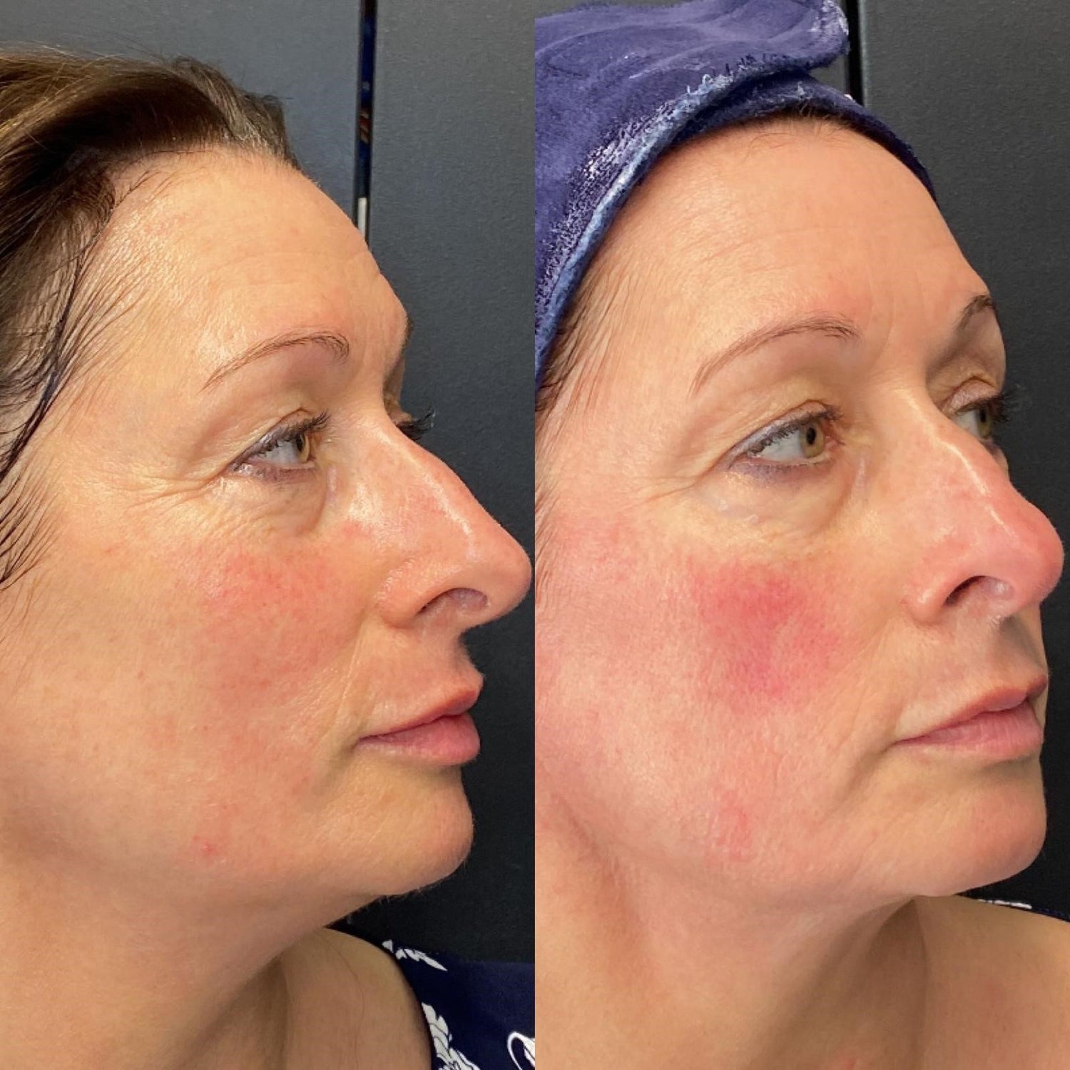 Collagenwave Treatment in Market Harborough | NG Skin Clinic